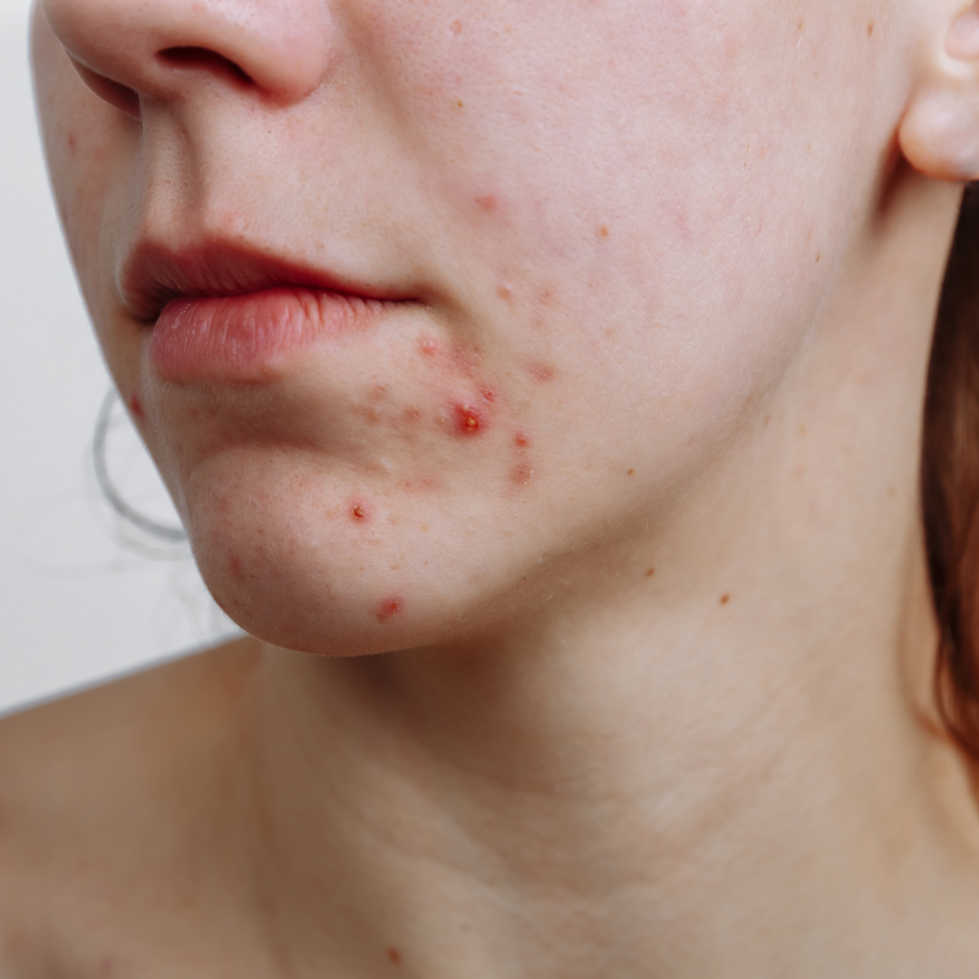 The Deficiency that causes both Acne & Fertility Struggles—& the Easy ...